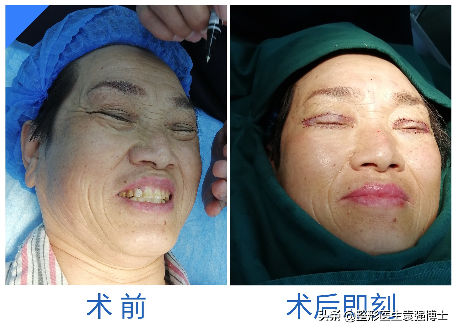 Can double eyelids, eyebrow lifts and eye bags be done together?65-year ...