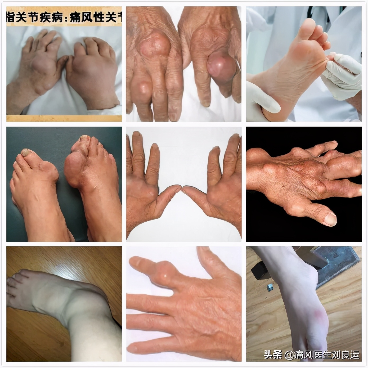 Tophi has seven characteristics and four negligences. There are three ...