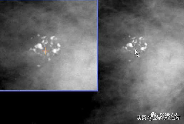 Differential diagnosis and grading of breast calcification - iNEWS